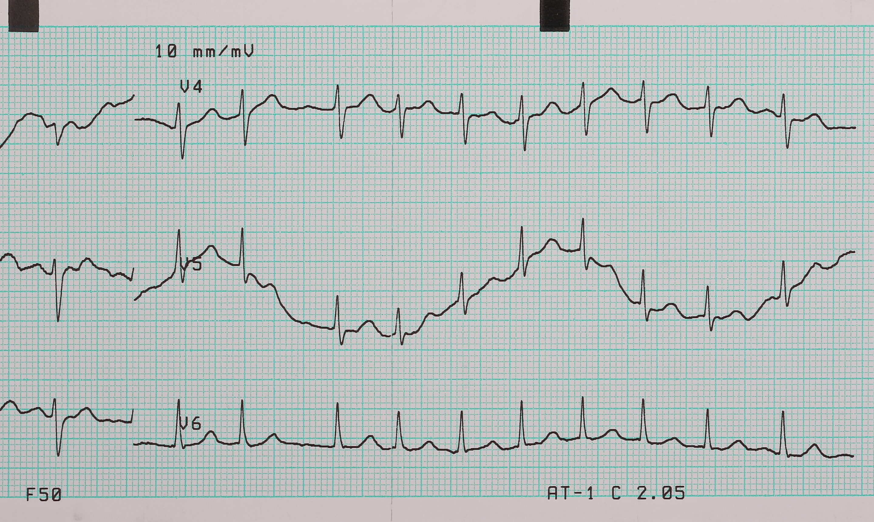 Chronic Heart Failure and Social Security Disability Guide